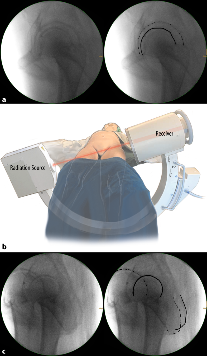 Fluoroscopically guided acetabular posterior column screw fixation via ...
