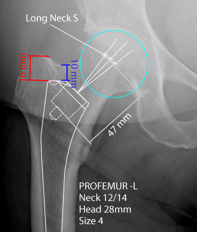 Supercapsular percutaneously assisted (SuperPath) approach in total hip ...