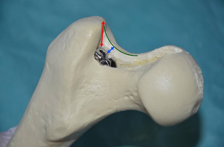 Supercapsular percutaneously assisted (SuperPath) approach in total hip ...
