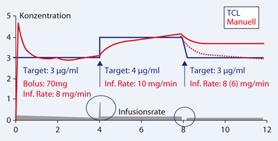 „Target controlled infusion“ (TCI) – ein Konzept mit Zukunft ...