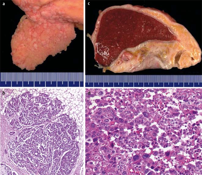 Peritonealmetastasen in der pathologisch-anatomischen Befundung ...