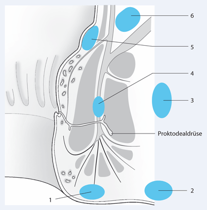 Fisteln und Fissuren | SpringerLink
