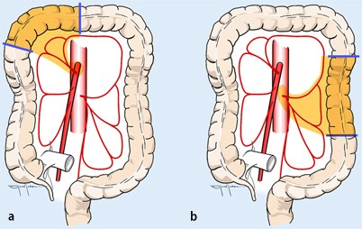 Lymphknotendissektion bei Karzinomen des unteren ...