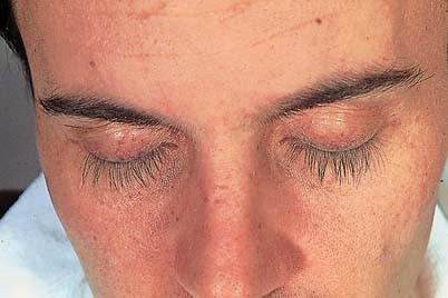 Hypertrichose | SpringerLink