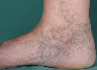 Chronische venöse Insuffizienz | SpringerLink