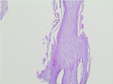 Dermatophytid | SpringerLink