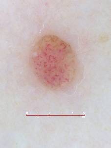 Dermatoskopie bei malignen und benignen Hauttumoren | SpringerLink