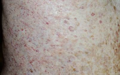 Kutane Graft-versus-Host-Erkrankung | SpringerLink