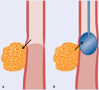 Endoskopische Vakuumschwammtherapie | SpringerLink