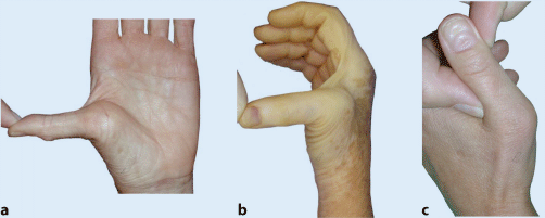 Behandlung der Instabilität des Daumengrund- und des ...