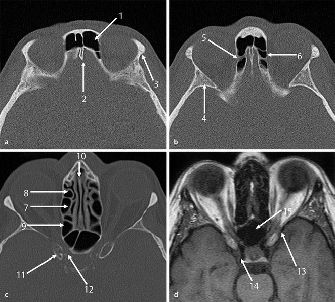 Anatomie und Normvarianten der Nasennebenhöhlen in der ...