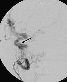 Diagnostik und Therapie duraler arteriovenöser Fisteln | SpringerLink