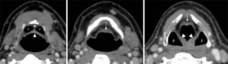 Radiologische Normalanatomie des Larynx und Pharynx sowie bildgebende ...