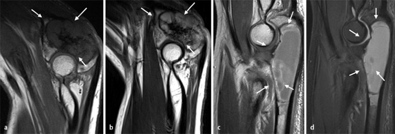 Bildgebung des Ellenbogengelenks mit Fokus MRT | SpringerLink