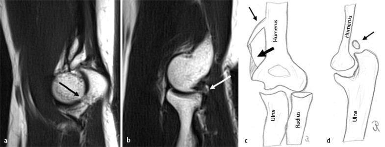 Bildgebung des Ellenbogengelenks mit Fokus MRT | SpringerLink