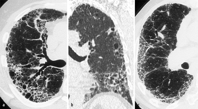 HRCT-Muster der wichtigsten interstitiellen Lungenerkrankungen ...