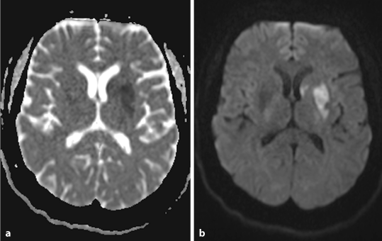 Diffusionsgewichtete Bildgebung bei akutem Schlaganfall | SpringerLink