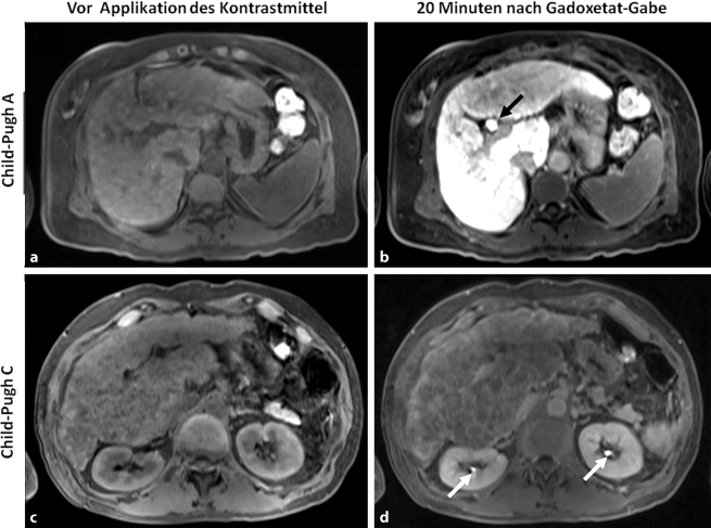 Funktionelle MR-Tomographie der Leber | SpringerLink