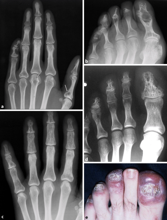 Skelettsarkoidose | SpringerLink