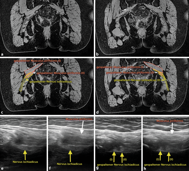 Bildgebung des Plexus lumbosacralis | SpringerLink
