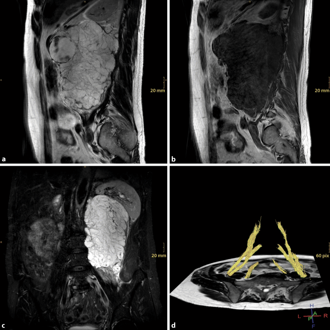 Bildgebung des Plexus lumbosacralis | SpringerLink