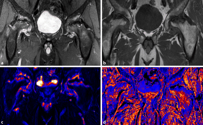 Posttherapeutische Veränderungen am Knochenmark | SpringerLink