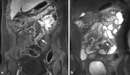 Bildgebung gastrointestinaler Entzündungen | SpringerLink