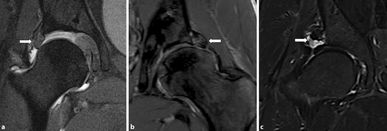 Labrumpathologie des Hüftgelenkes | SpringerLink