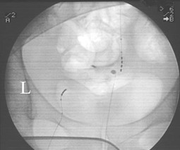 Nervus-pudendus-Neuralgie infolge Gewalttrauma | SpringerLink