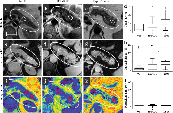 Pancreatic adipose tissue infiltration, parenchymal steatosis and beta ...