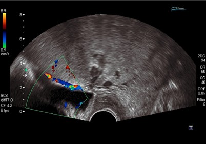 Placenta praevia marginalis increta | SpringerLink