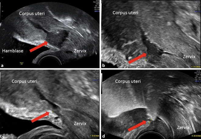 Spätfolgen der Sectioentbindung: Narbendefekte und ...