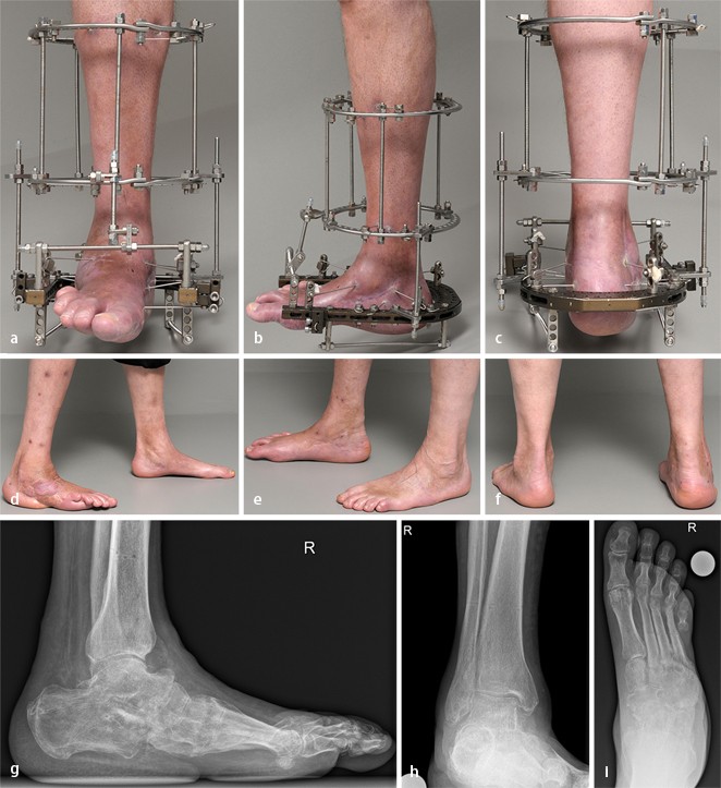 Komplexe Rekonstruktionen bei Charcot-Arthropathie mittels Ilizarov ...
