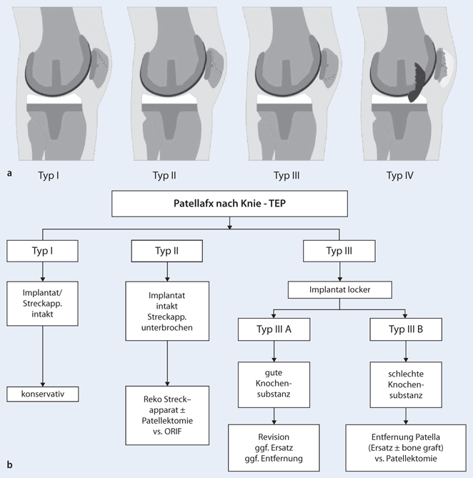 Periprothetische Frakturen des Kniegelenkes | SpringerLink