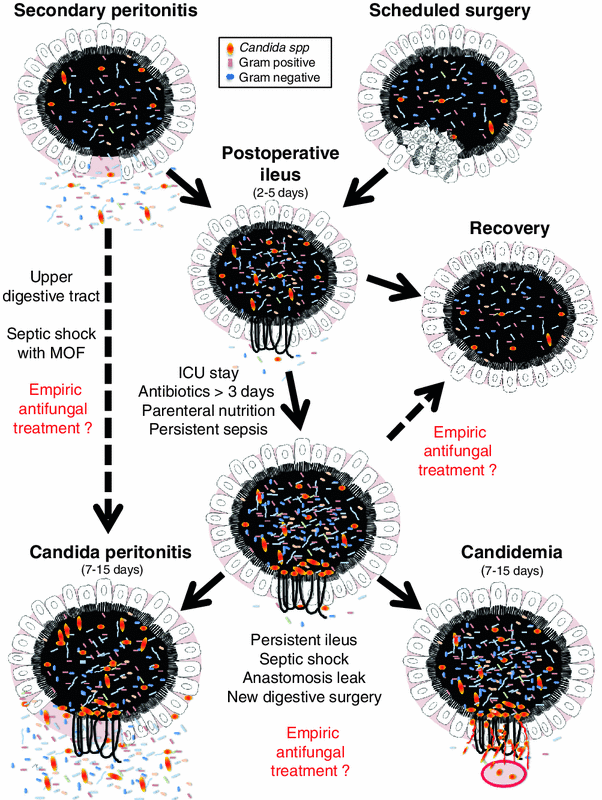 Intra-abdominal candidiasis: the guidelines—forgotten non-candidemic ...