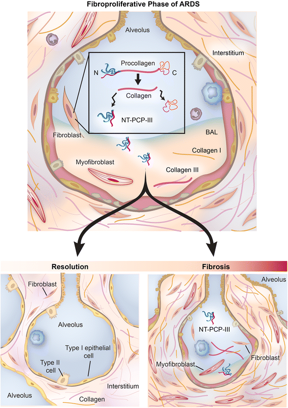 Biology and pathology of fibroproliferation following the acute ...