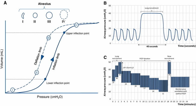 Understanding recruitment maneuvers | SpringerLink