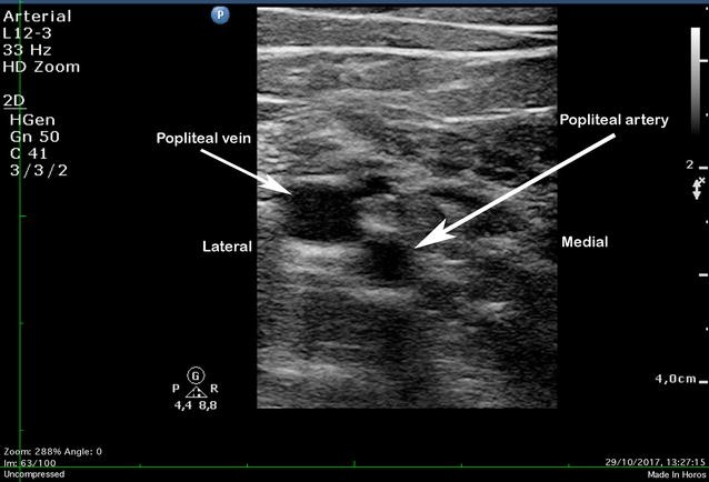 Fast confirmation of correct position of distal perfusion cannula ...