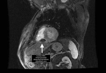Intramyocardial dissecting hematoma of right ventricle following a ...