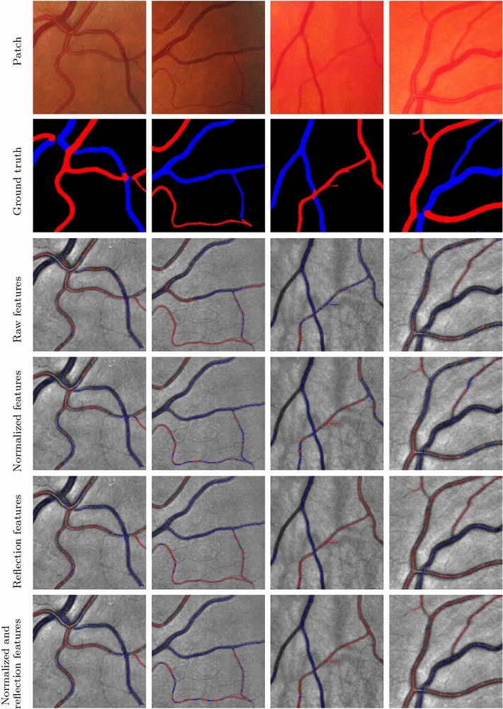 Artery/vein classification using reflection features in retina fundus ...