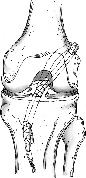 Anatomic double bundle ACL reconstruction: a literature review ...