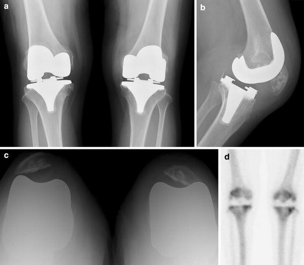 TKA using the subvastus approach and lateral retinacular release in ...