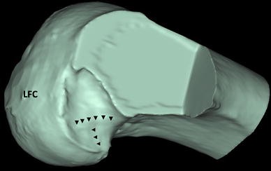 Does the lateral intercondylar ridge disappear in ACL deficient ...