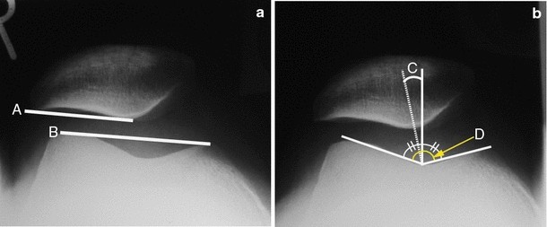 Effects of medial patellofemoral ligament reconstruction on patellar ...