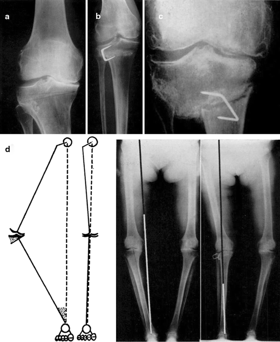 Osteotomy around the knee: evolution, principles and results | SpringerLink