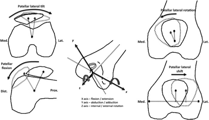 Patellar thickness and lateral retinacular release affects ...