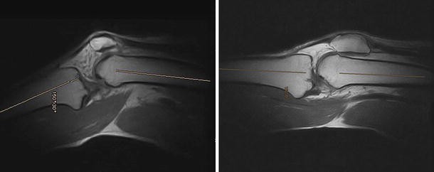 Influence of knee flexion angle and weight bearing on the Tibial ...