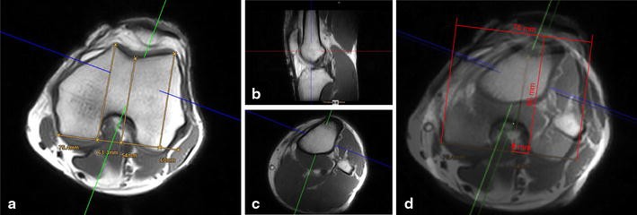Influence of knee flexion angle and weight bearing on the Tibial ...