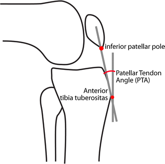 Comparison of stability and kinematics of the natural knee versus a PS ...