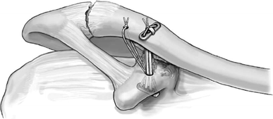 A biomechanical assessment of a novel double endobutton technique ...